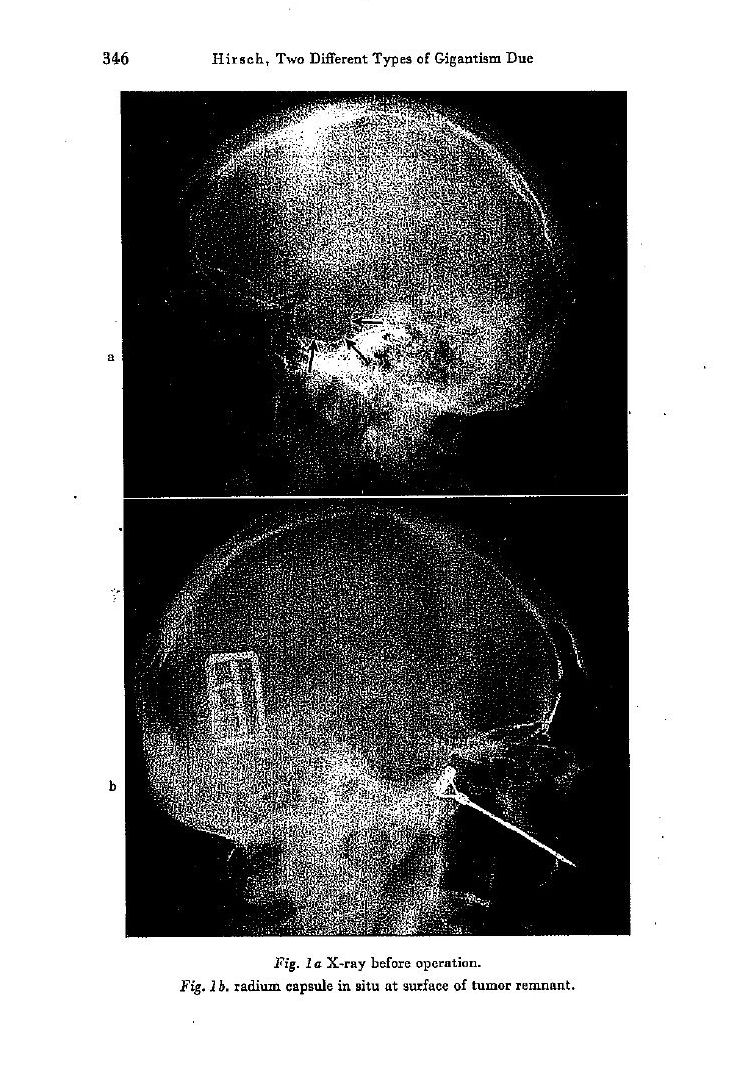 Adam Rainer - The tallest man Austria