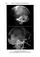 Adam Rainer - The tallest man Austria