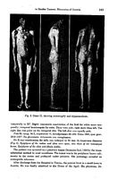 Adam Rainer - The tallest man Austria