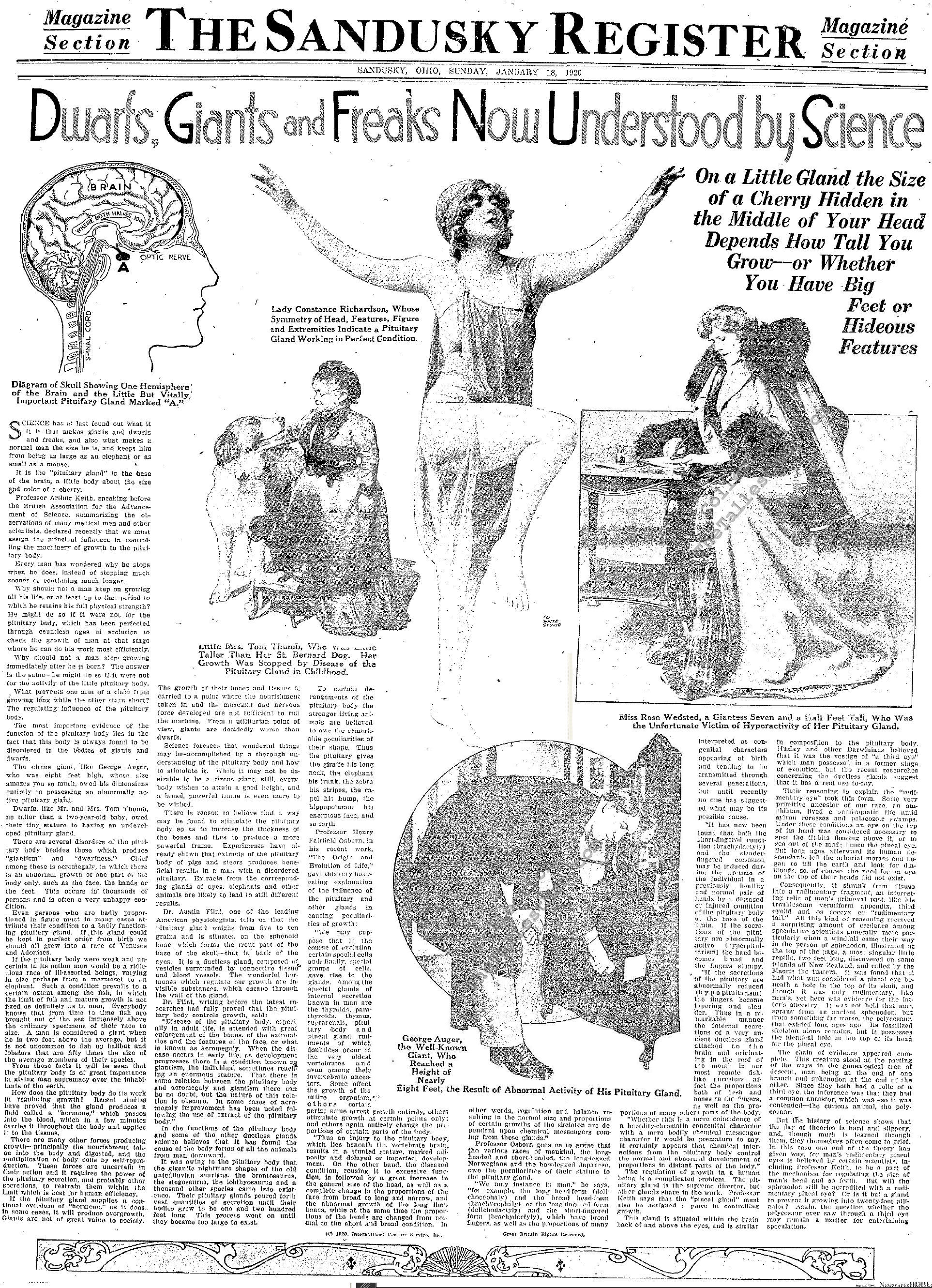 Pituitary Gigantism acromegaly enuchoid giantism Marfan Syndrome